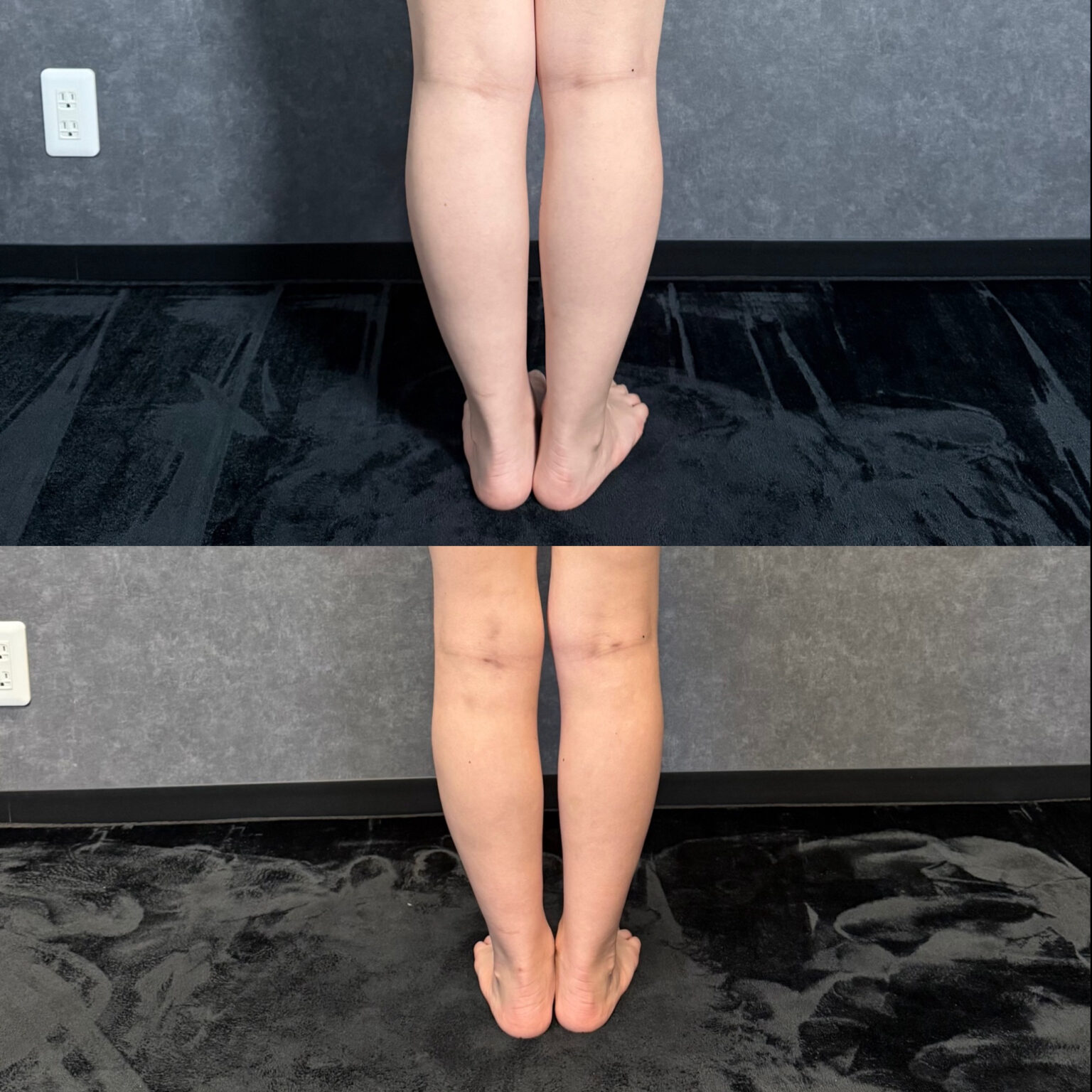 Calf Liposuction — Benefits and Key Considerations | AVAN TOKYO 銀座脂肪吸引クリニック